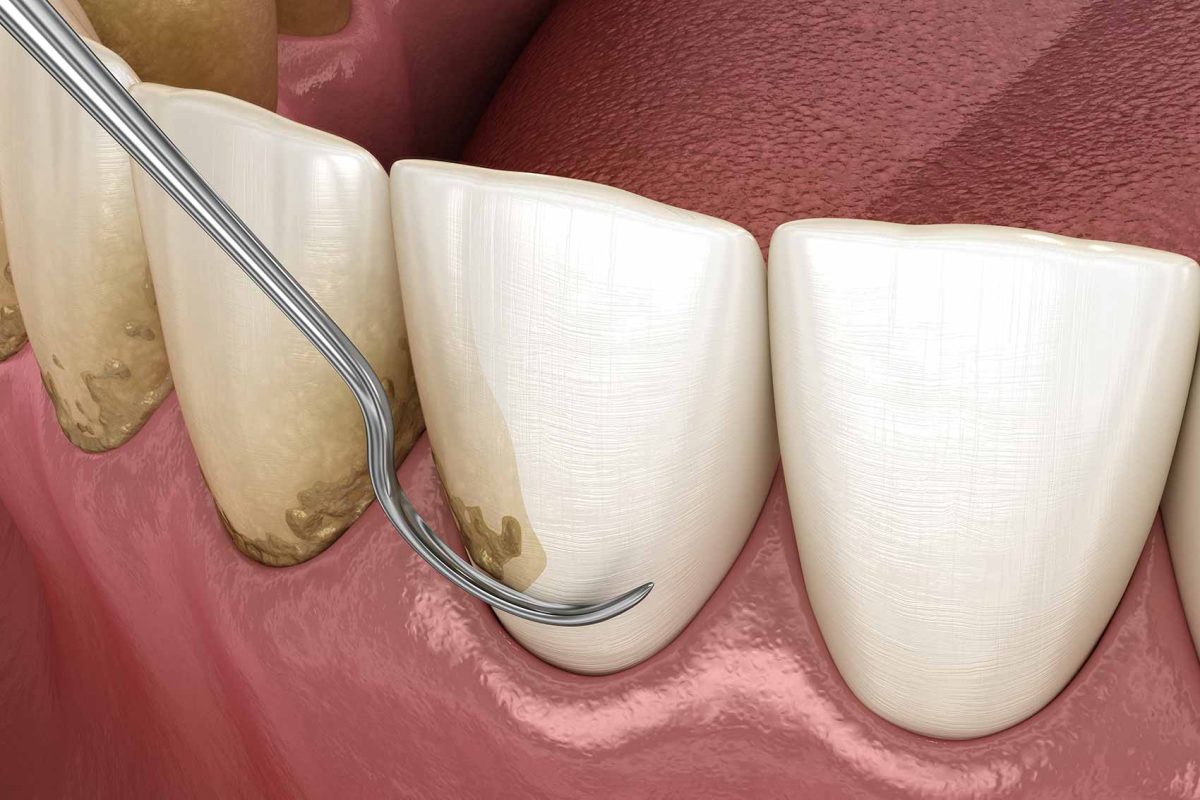 Dental Tartar vs Dental Plaque: What is the Difference?